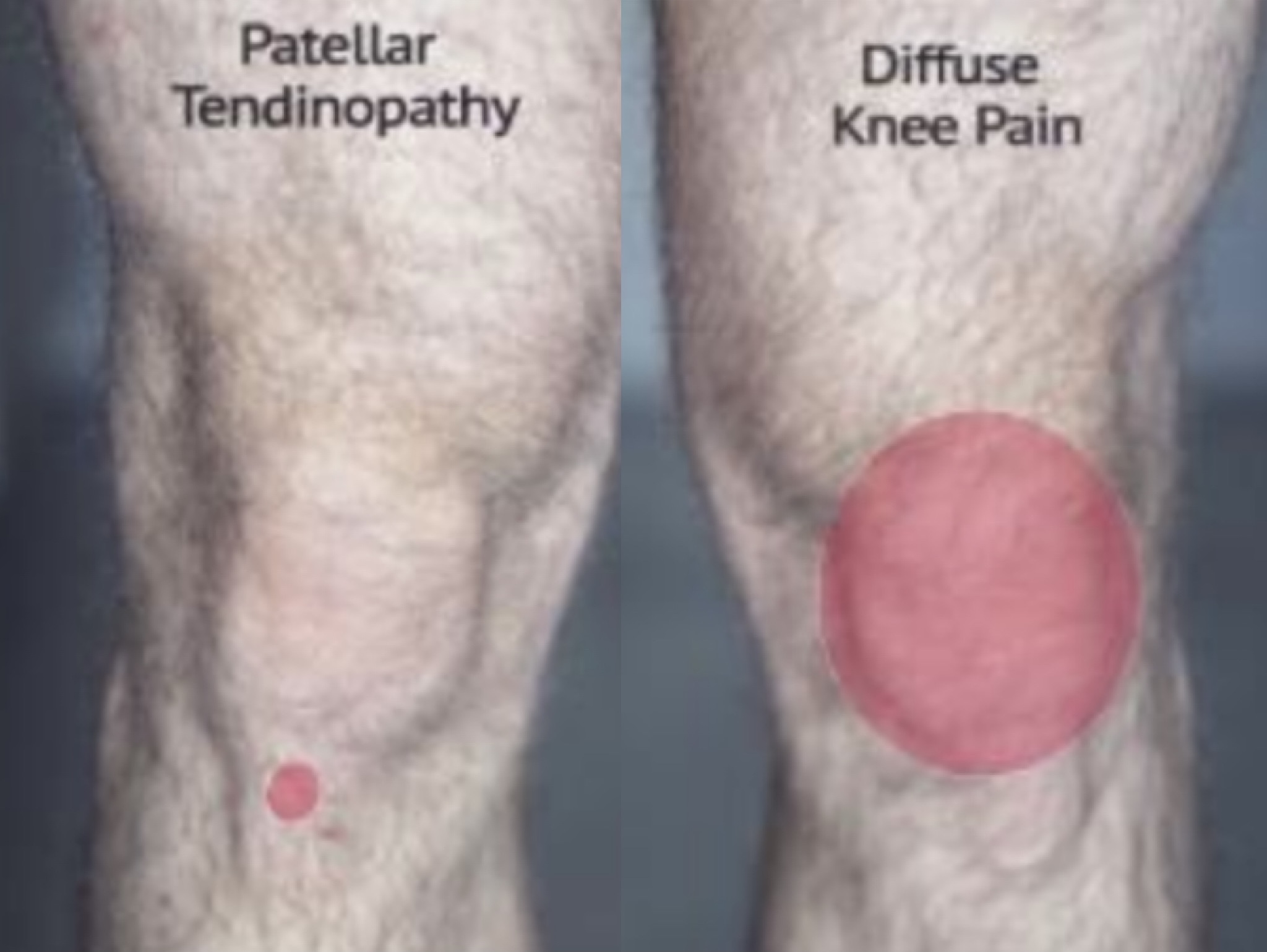 Jumper’s Knee: 61 Things I’ve Learned [Fix Patellar Tendon Pain ...